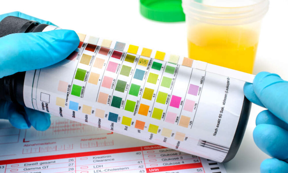 Catecolamine urinarie: cosa sono, totali, valori. Alte e basse